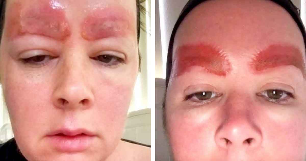Mom's skin falls off after microblading procedure goes horribly wrong ...