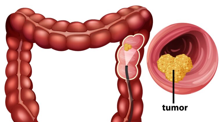 Poop and Colon Cancer: Early Warning Signs, When to Seek Help
